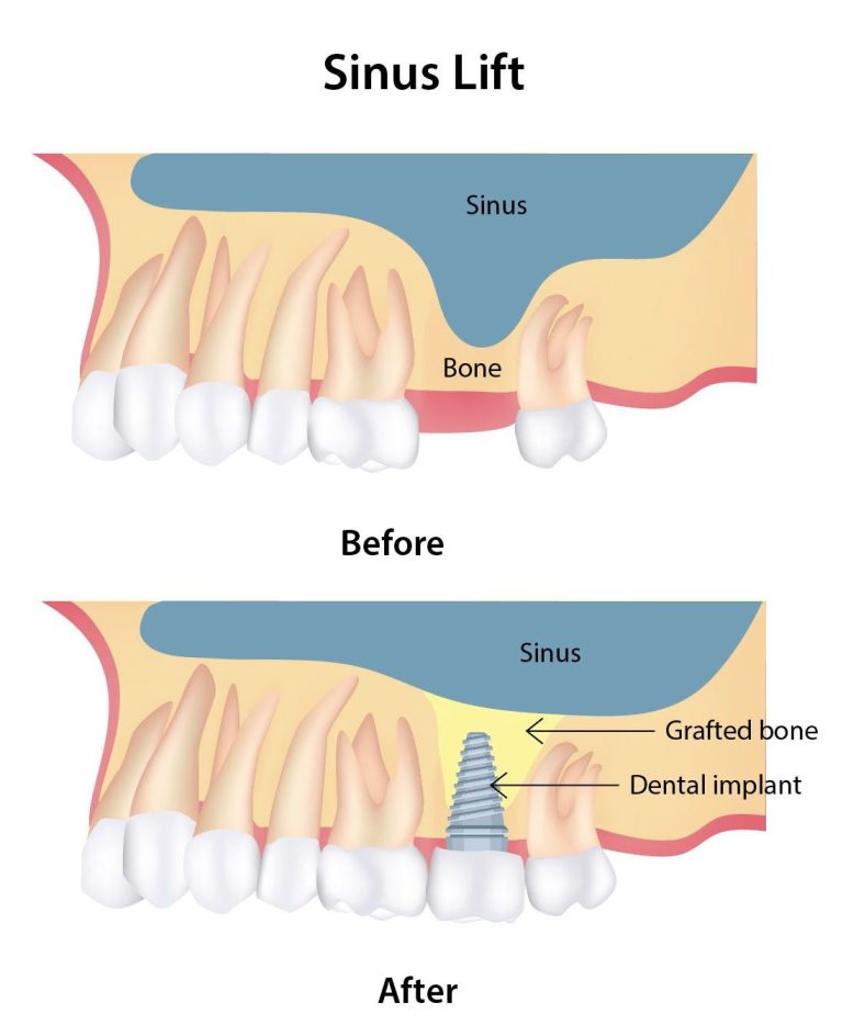 Sinus Lift dental implants Perth